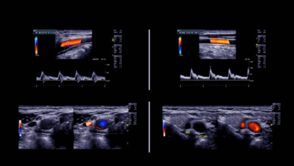 Color Doppler Ultrasound System